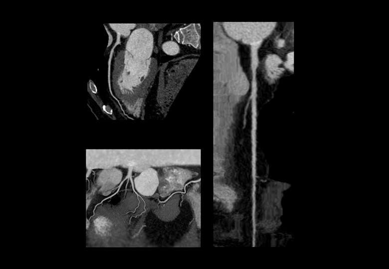 256-slice Spiral CT Scanner