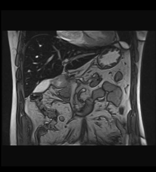 Superconducting MRI System