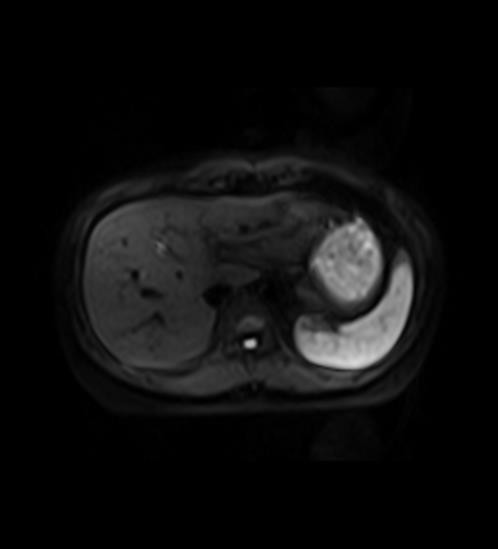 Superconducting MRI System