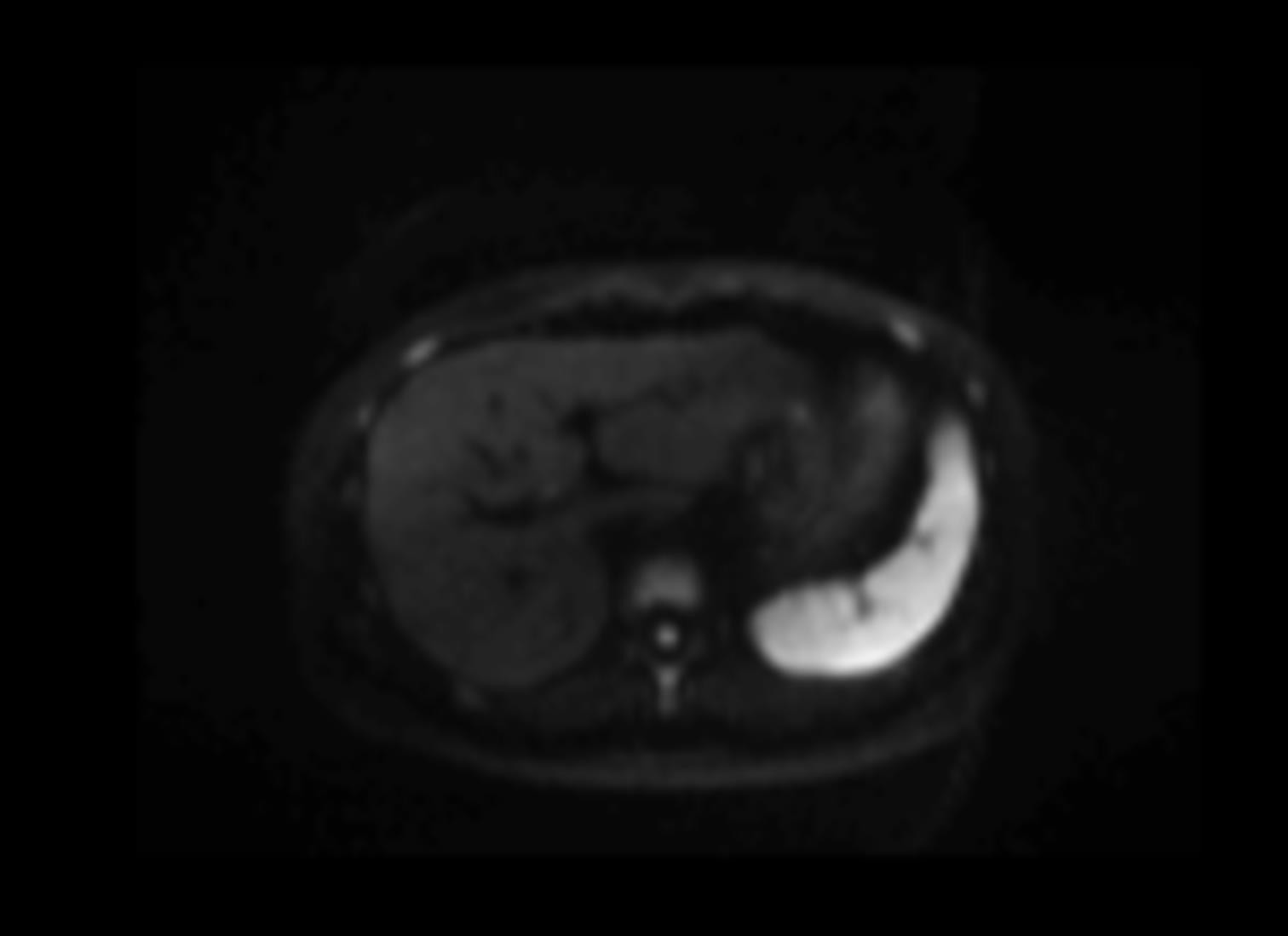 Superconducting MRI System