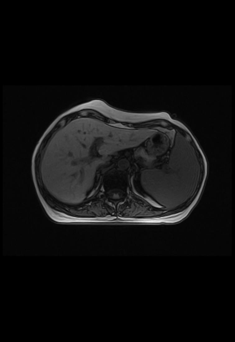 Superconducting MRI System