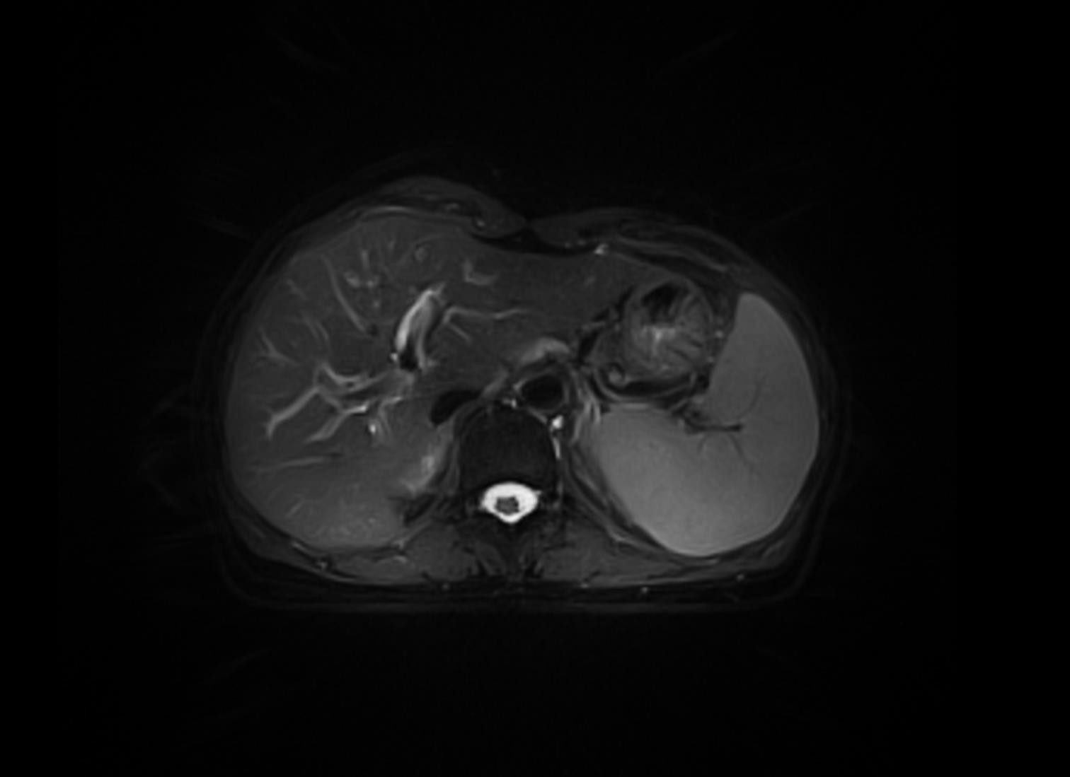 Superconducting MRI System