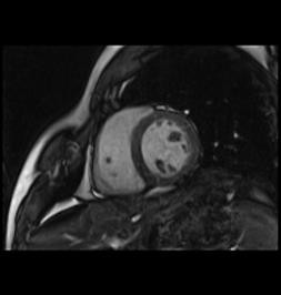 Superconducting MRI System