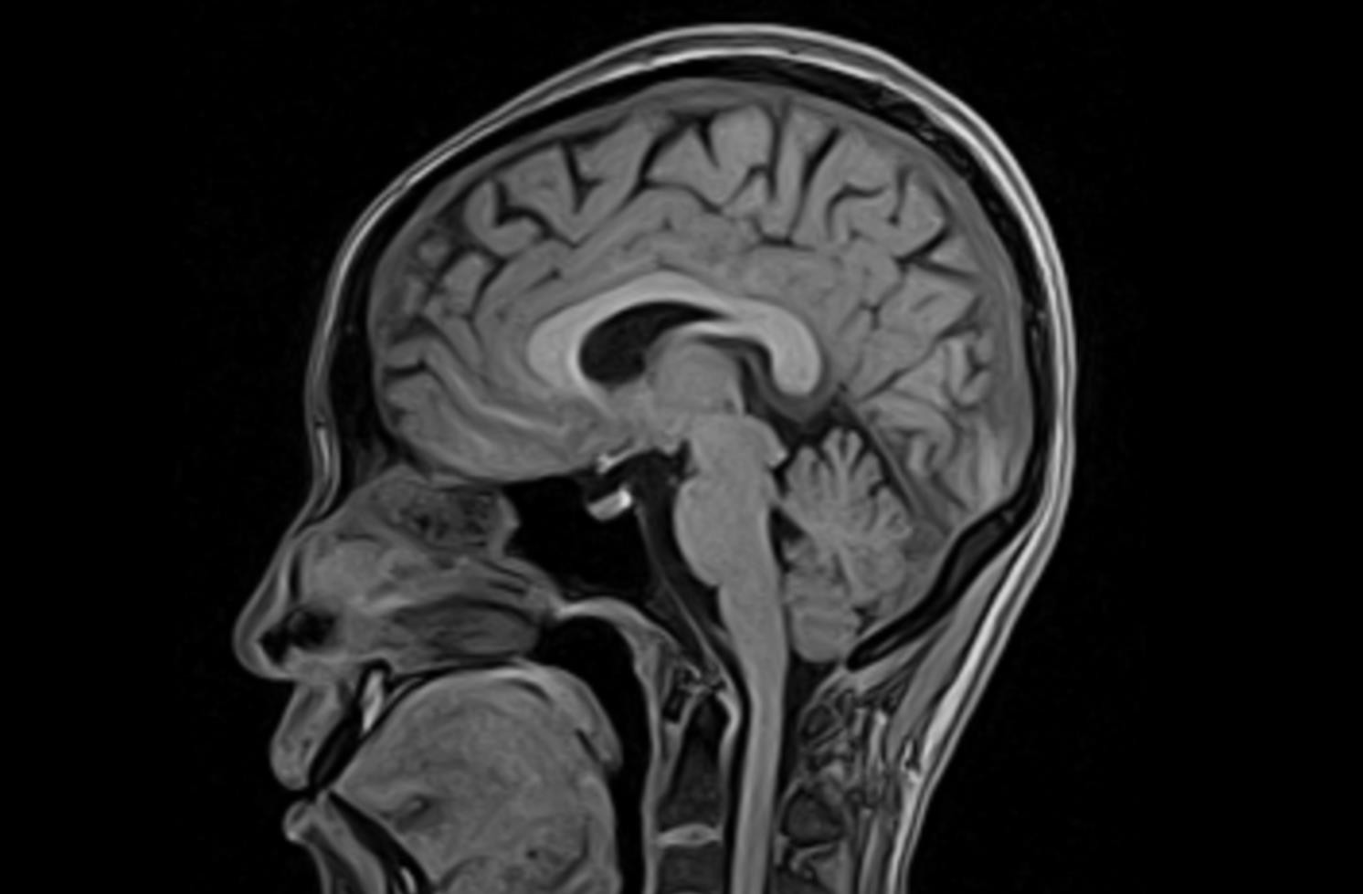 Superconducting MRI System