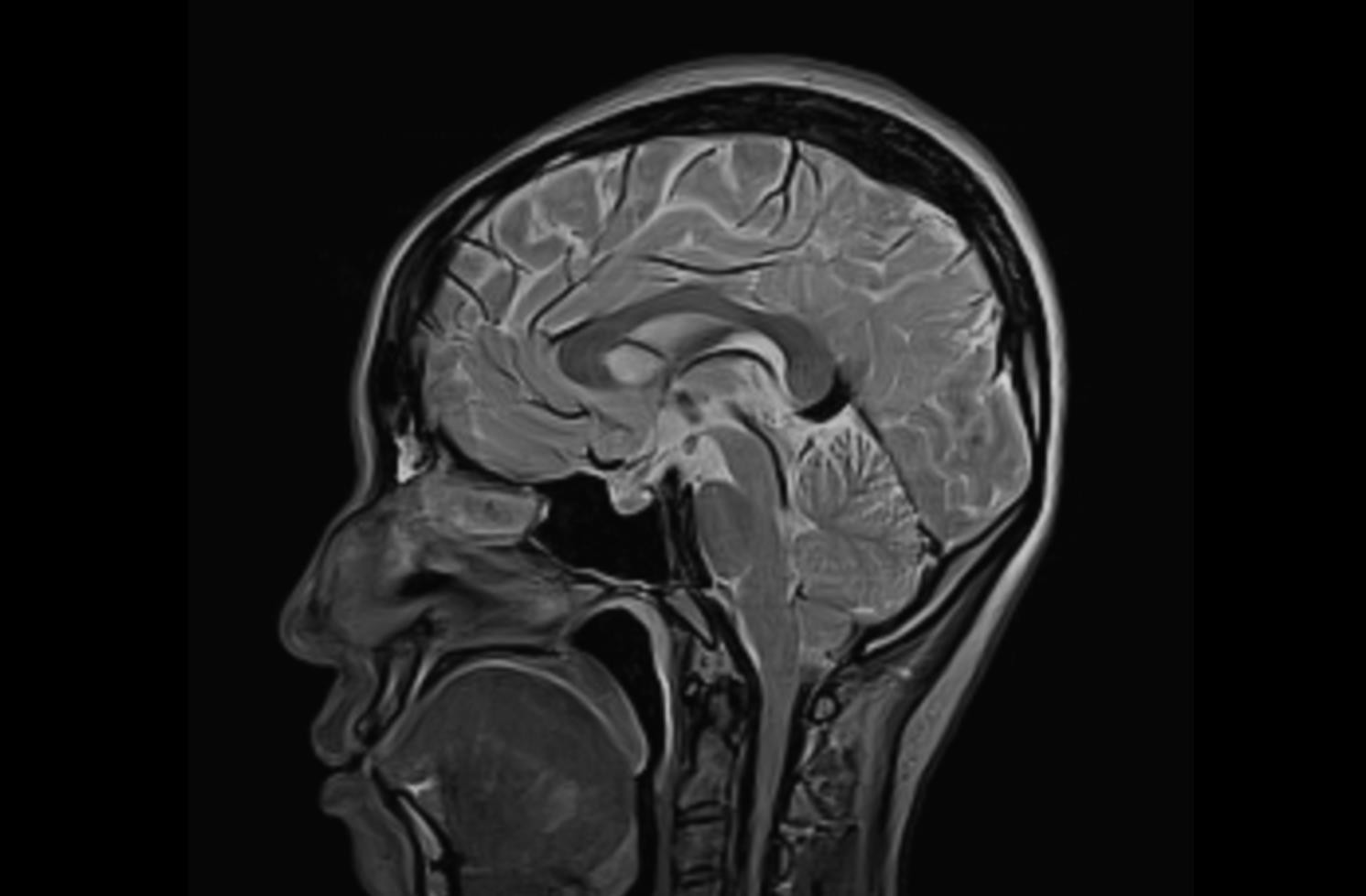 Superconducting MRI System